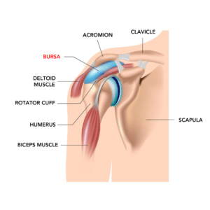 Shoulder Bursitis & The Role of Exercise Physiology in Rehab